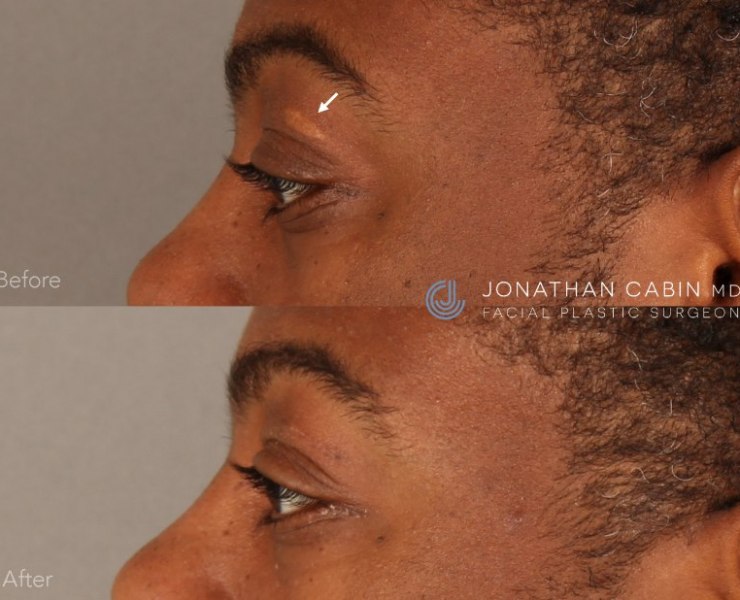 Eye and Brow Procedures Before & Afters | Dr. Jonathan Cabin