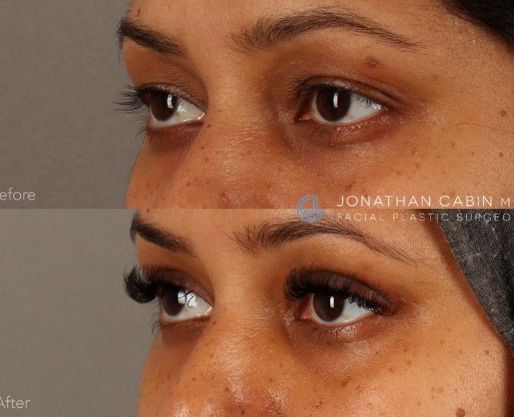 Eye and Brow Procedures Before & Afters | Dr. Jonathan Cabin