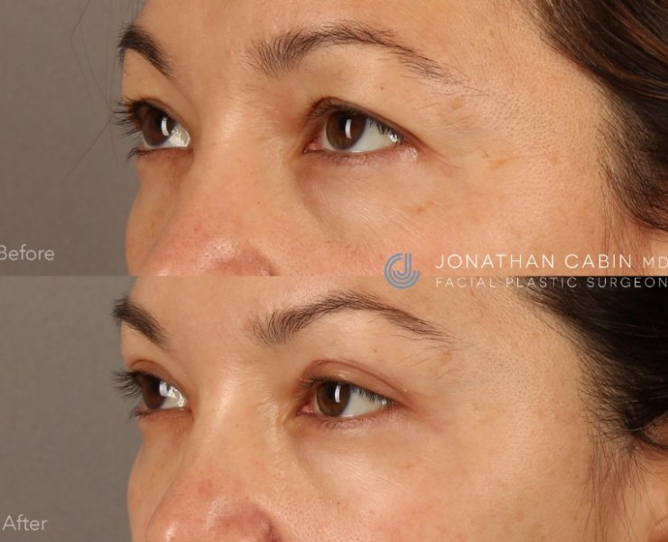 Eye and Brow Procedures Before & Afters | Dr. Jonathan Cabin