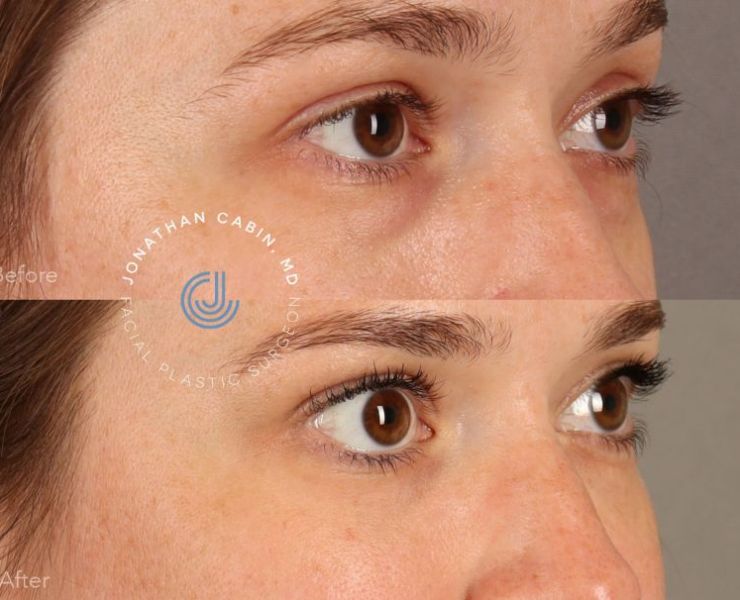 Eye and Brow Procedures Before & Afters | Dr. Jonathan Cabin