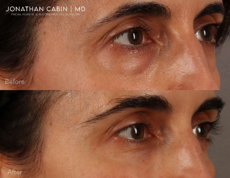 Eye and Brow Procedures Before & Afters | Dr. Jonathan Cabin