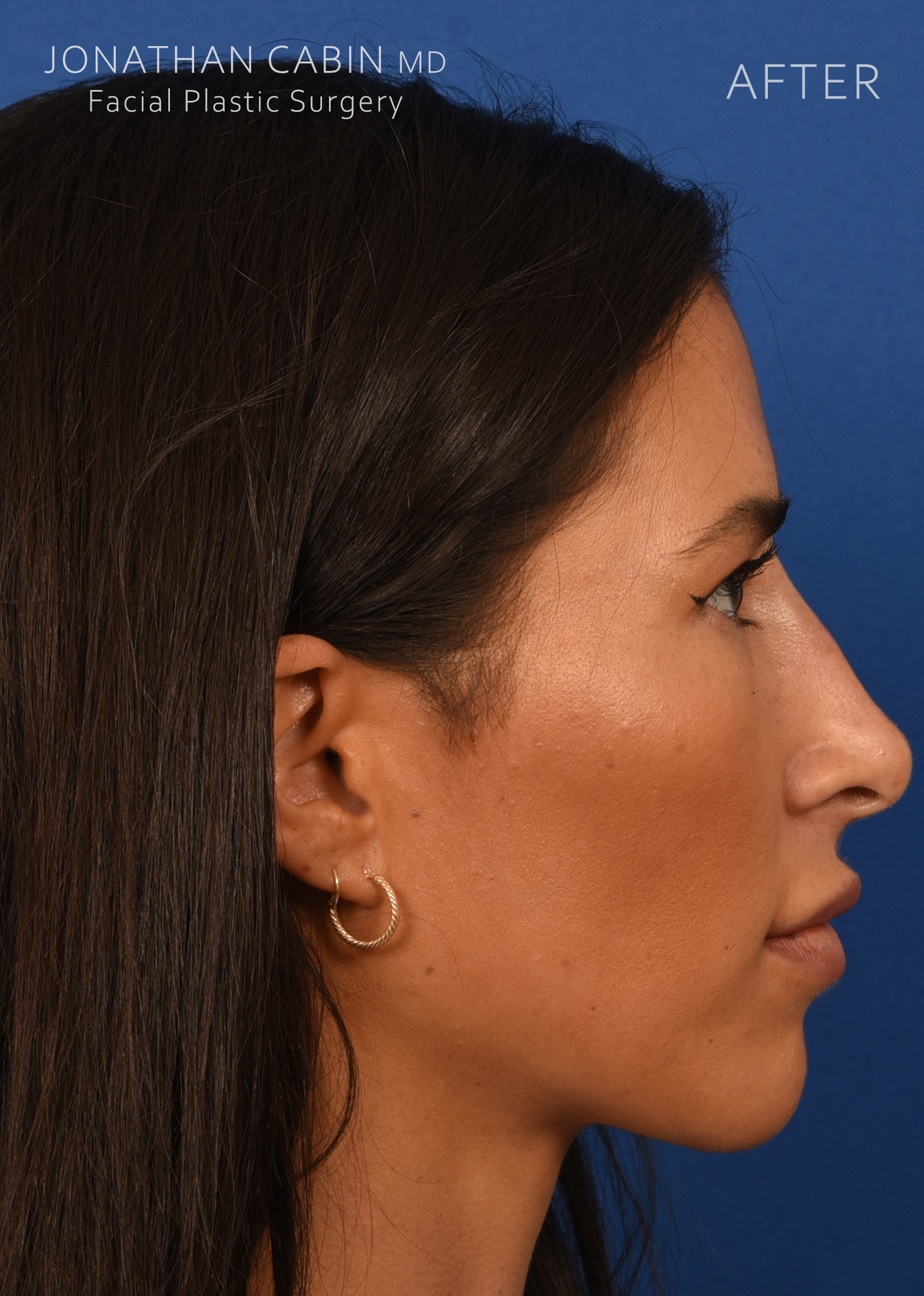 Non-Surgical Rhinoplasty | Dr. Jonathan Cabin | Liquid Rhinoplasty