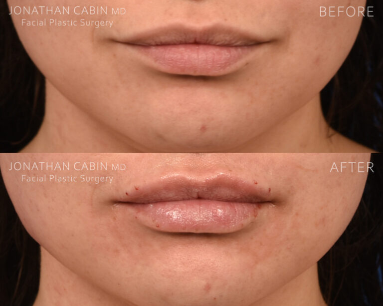 Lips Procedures Before & Afters | Dr. Jonathan Cabin