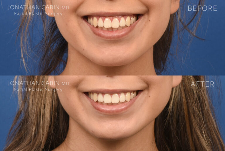 Smile Botox (Gummy Smile) - CabinMD Facial Plastics & Aesthetics