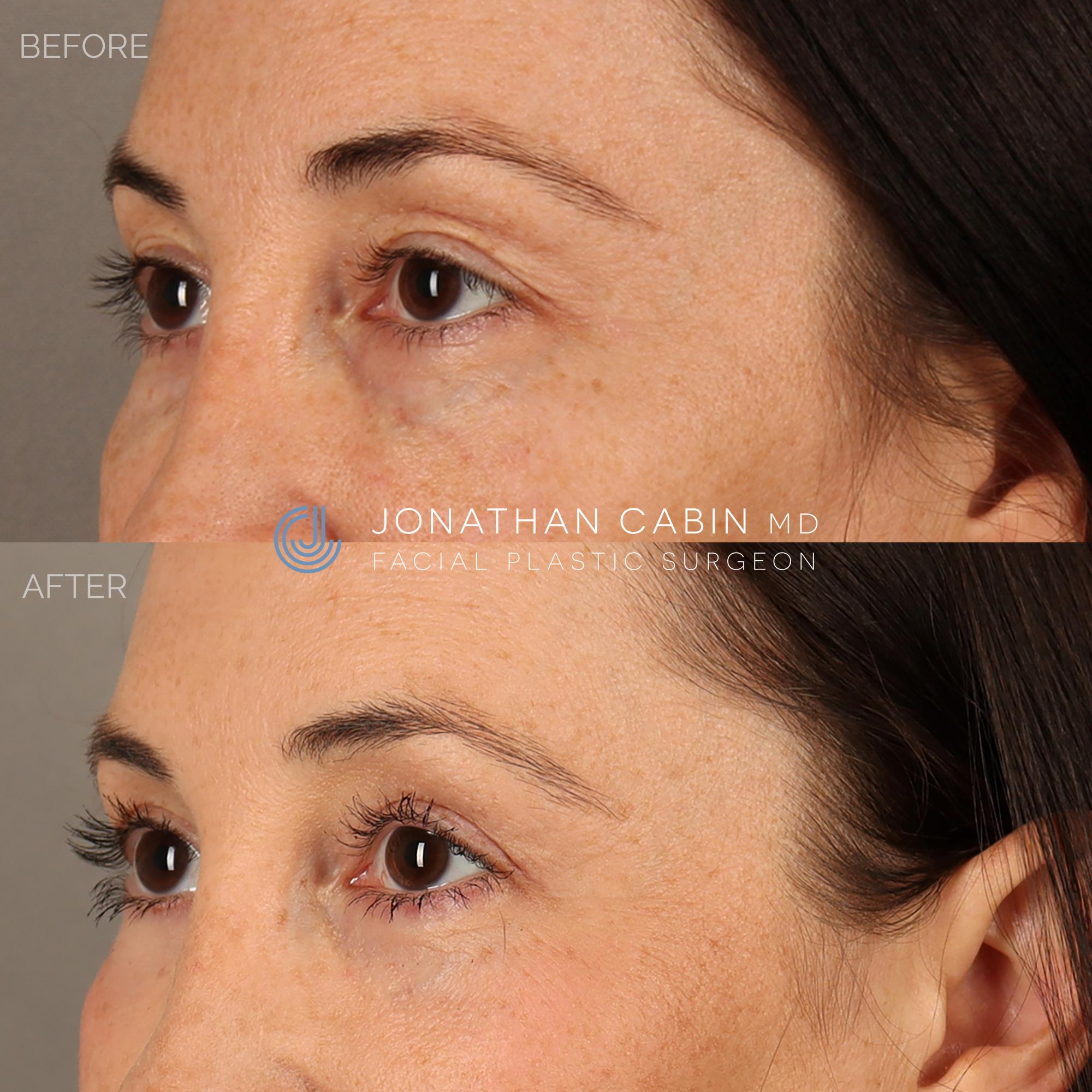 Deep Plane Facelift, Neck Lift, CO2 Laser Resurfacing - CabinMD Facial ...