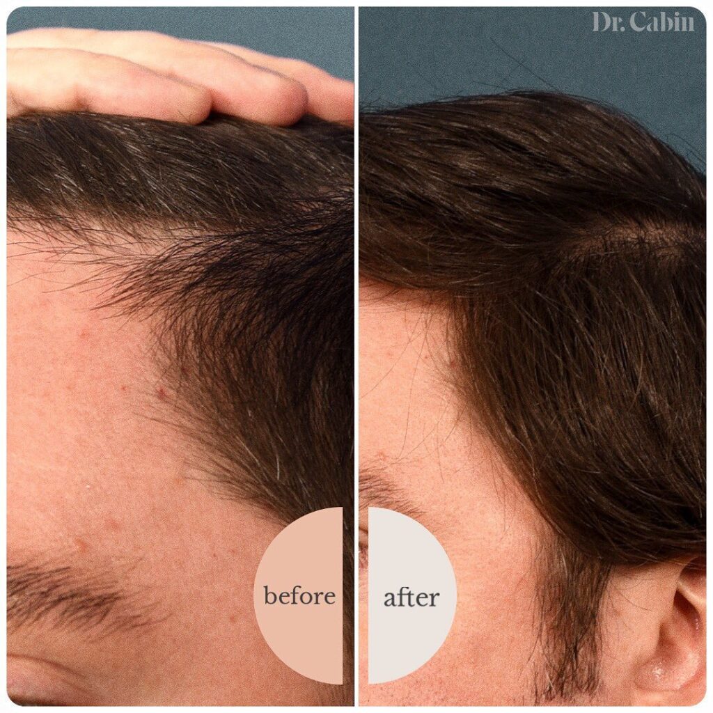 Hair Restoration Arlington | Dr. Jonathan Cabin | Restore Hair