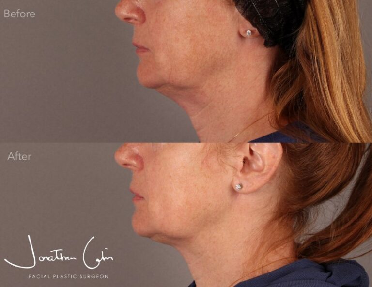 Face and Neck Procedures Before & Afters | Dr. Jonathan Cabin