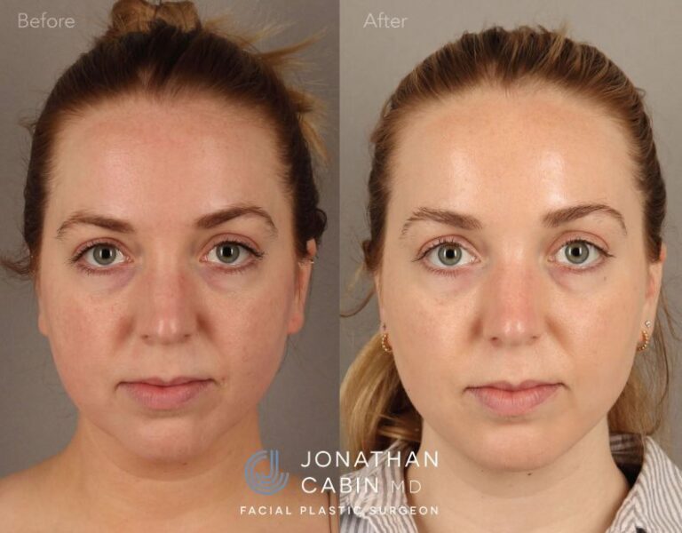 Face and Neck Procedures Before & Afters | Dr. Jonathan Cabin