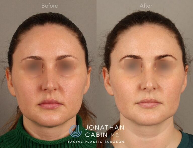 Deep Neck Lift with Buccal Fat Reduction and Fat Grafting - Dr ...