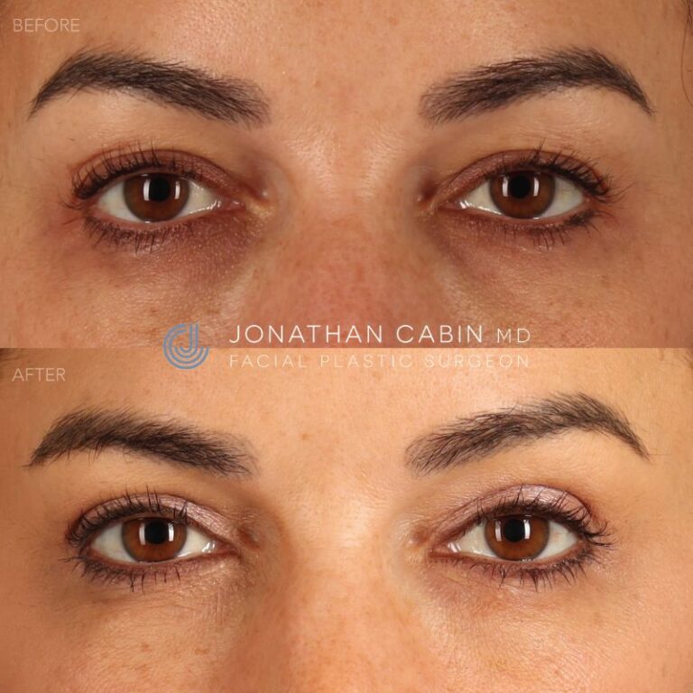 Eye and Brow Procedures Before & Afters | Dr. Jonathan Cabin