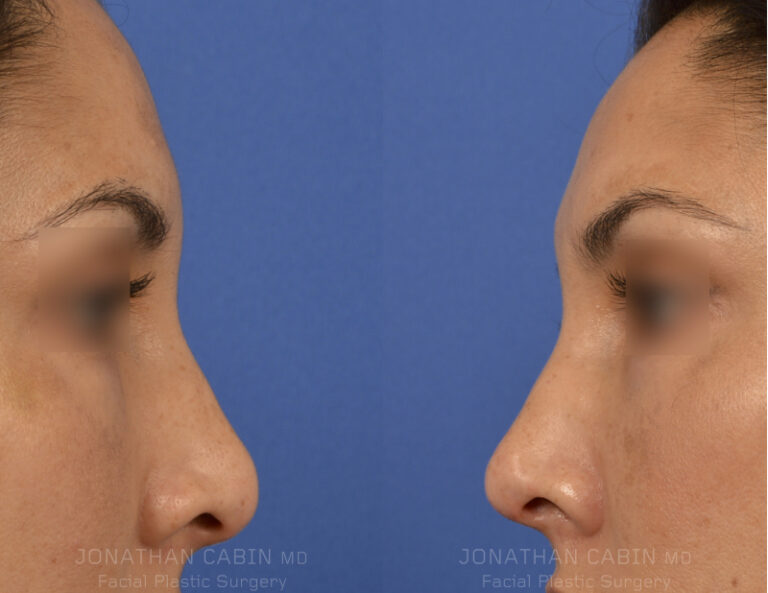Non Surgical Rhinoplasty Before And Afters Dr Jonathan Cabin