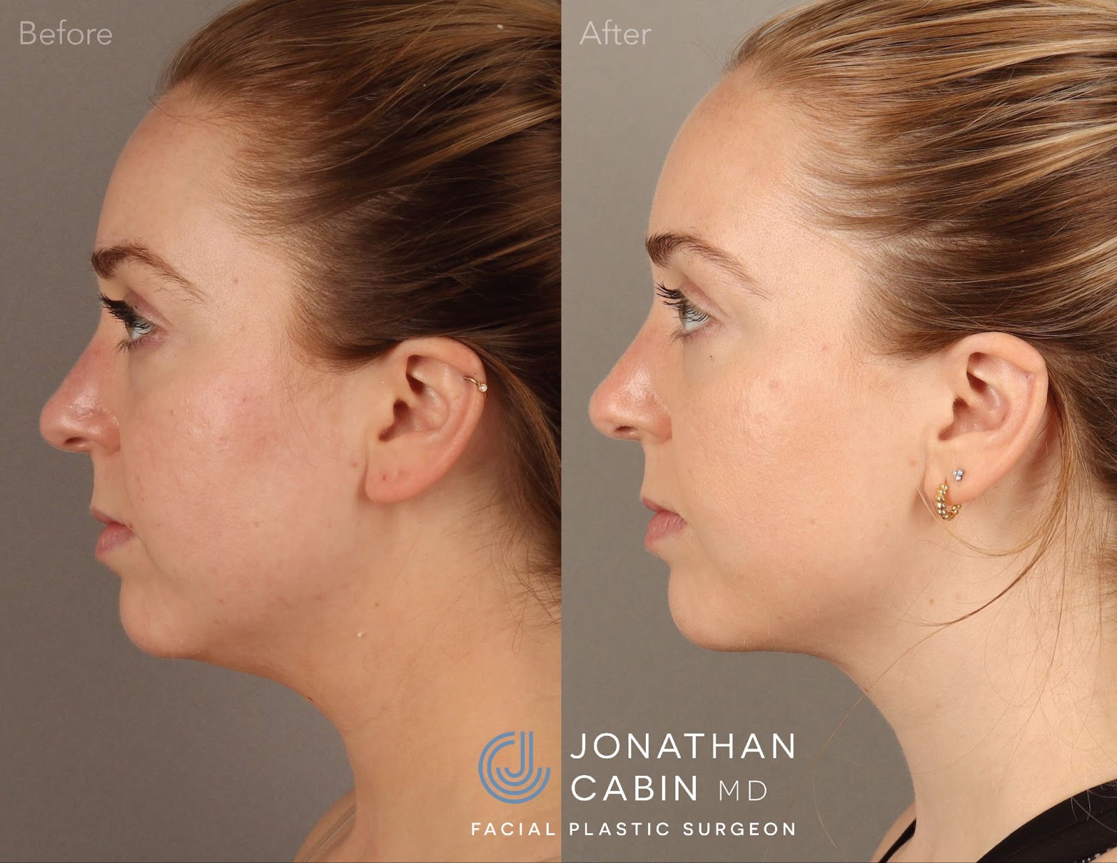 The Best Facial Procedures to Look Younger | Dr. Jonathan Cabin
