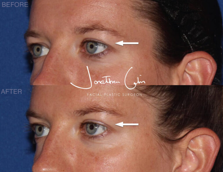 Brow Lifts and Botox | Dr. Jonathan Cabin | Facial Rejuvenation