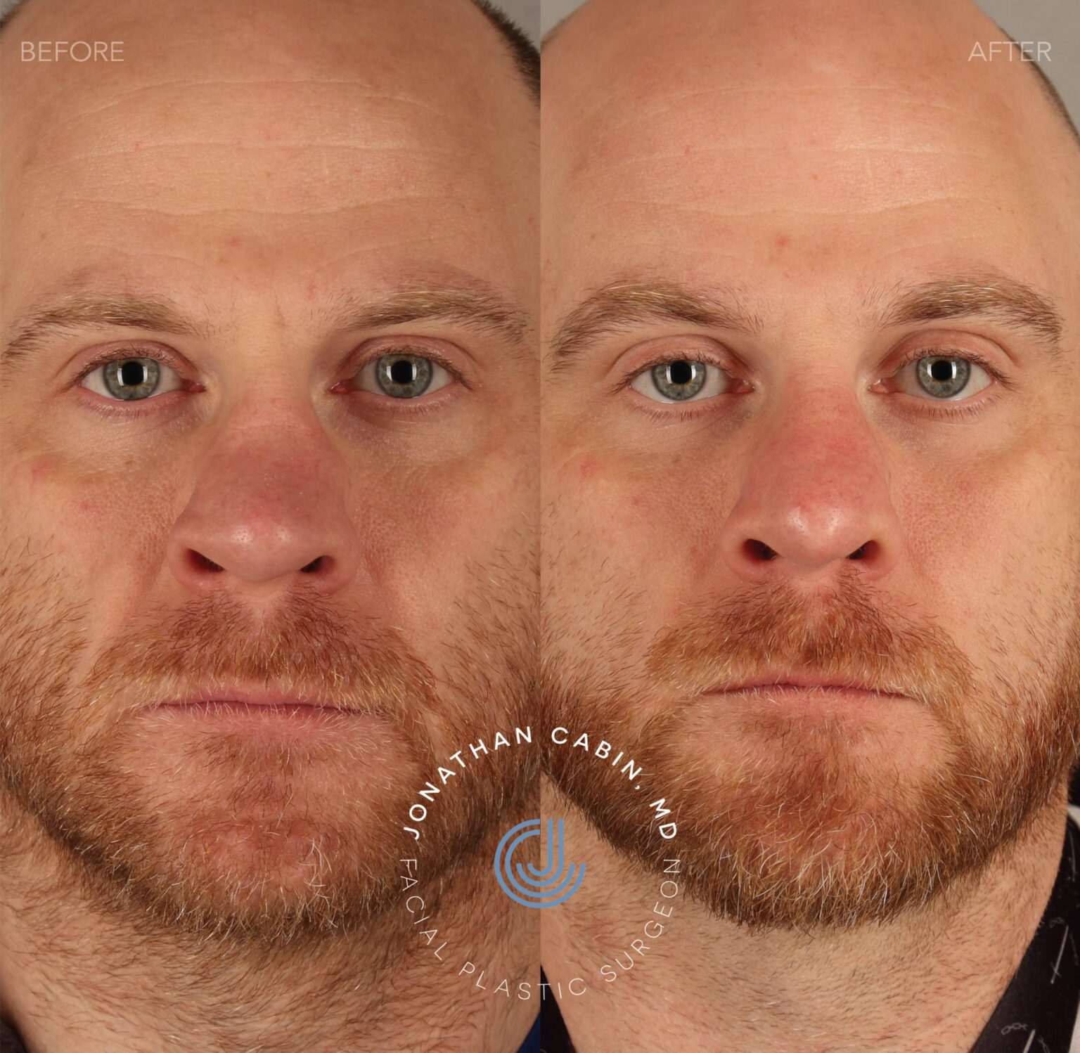Non-Surgical Rhinoplasty Before & Afters | Dr. Jonathan Cabin
