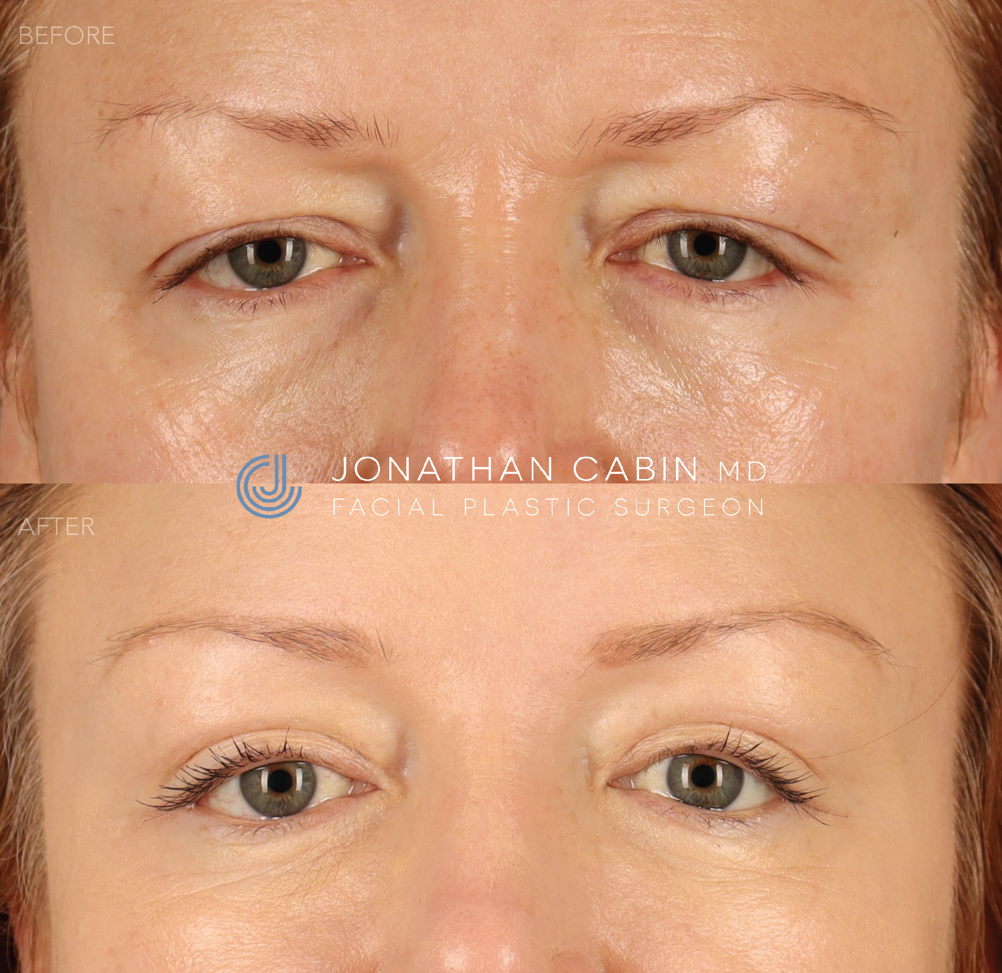 Eye and Brow Procedures Before & Afters | Dr. Jonathan Cabin