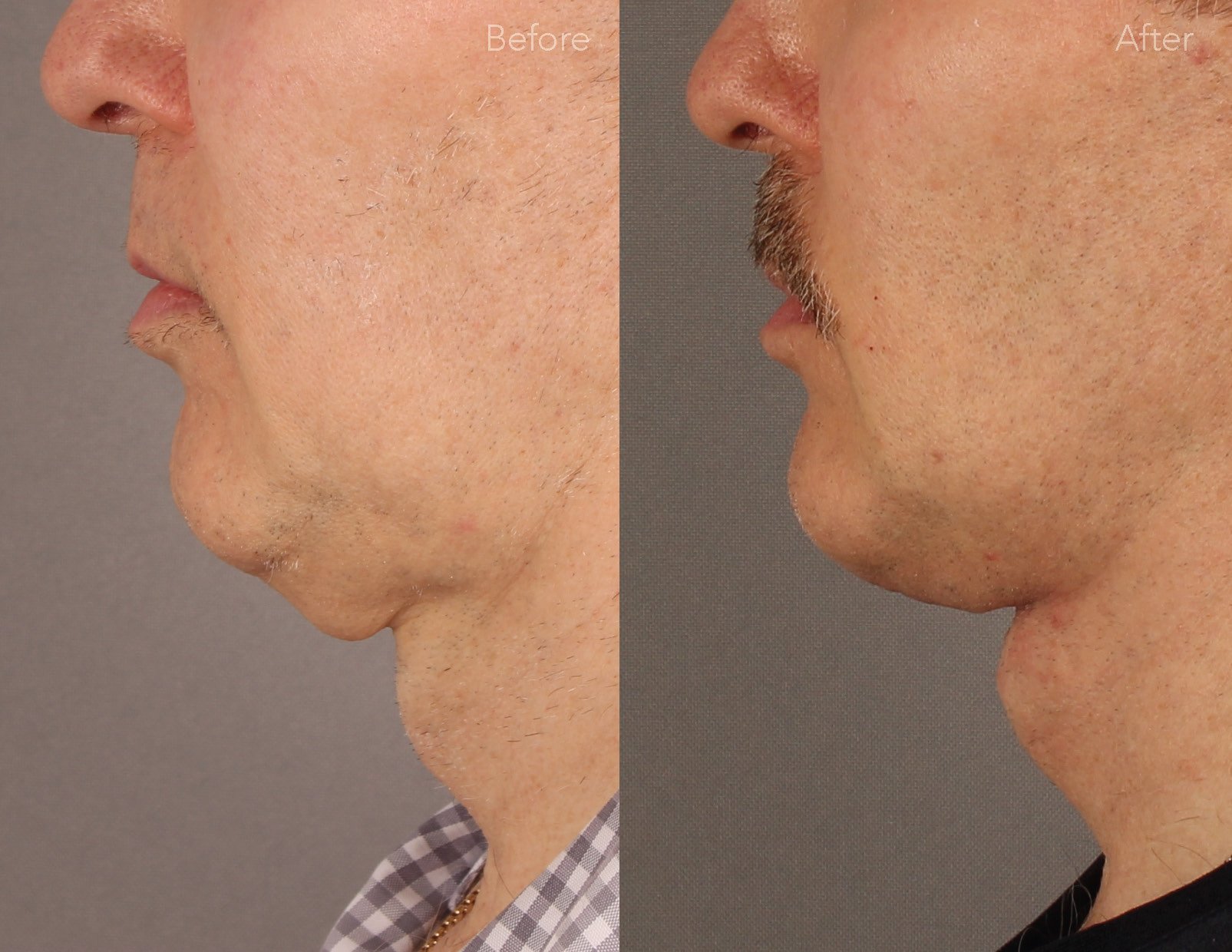 What to Know Before Getting a Neck Lift | CabinMD Facial Plastics ...