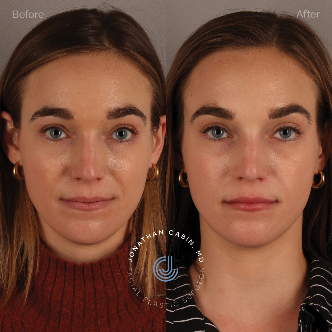 Forehead Botox - Dr. Jonathan Cabin