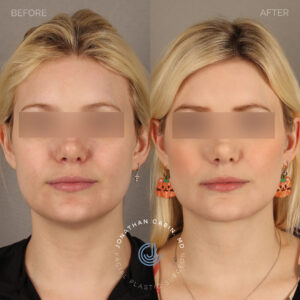 Face and Neck Procedures Before & Afters | Dr. Jonathan Cabin
