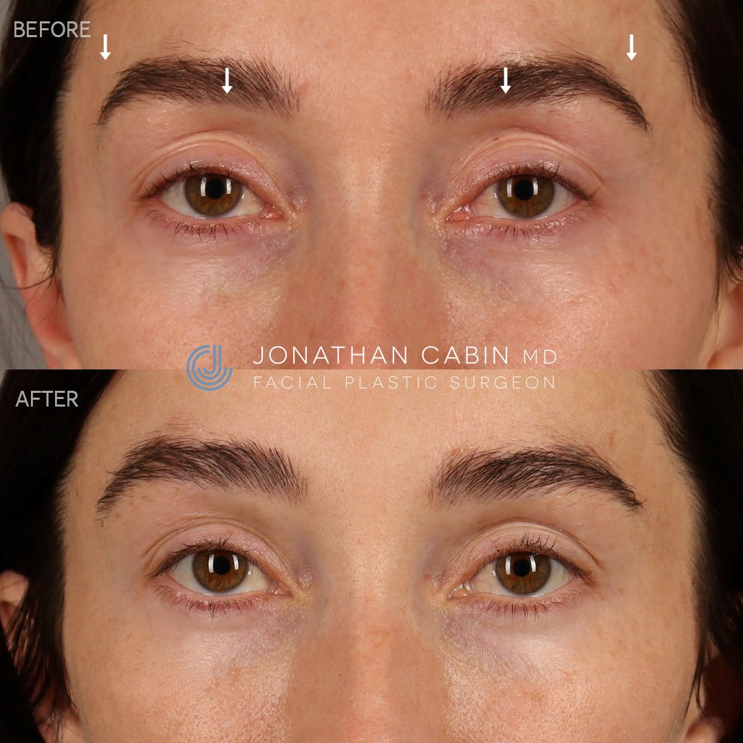 Can You Get Natural-Looking Results with Botox & Fillers? | CabinMD ...