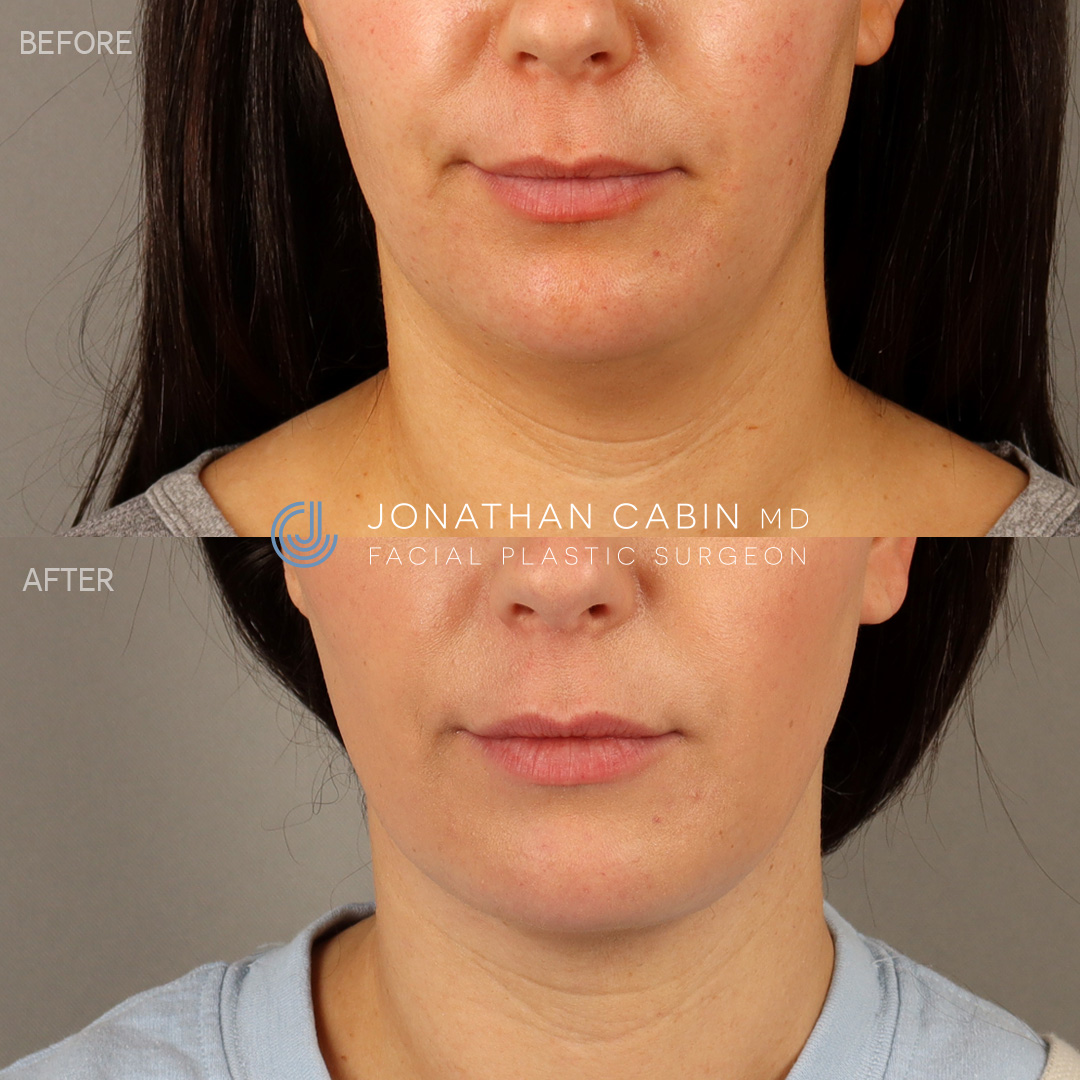 Face and Neck Procedures Before & Afters | Dr. Jonathan Cabin