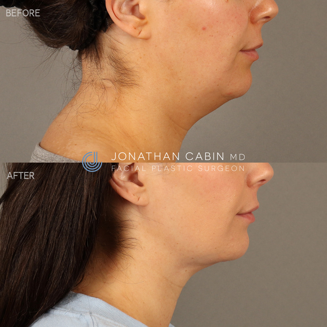 Deep Neck Lift & Facial Fat Grafting - CabinMD Facial Plastics & Aesthetics