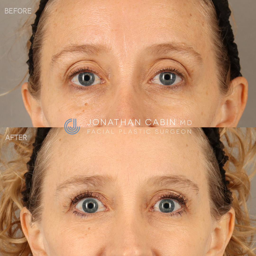 Upper Blepharoplasty with Fat Grafting to the Upper and Lower Eyelids ...