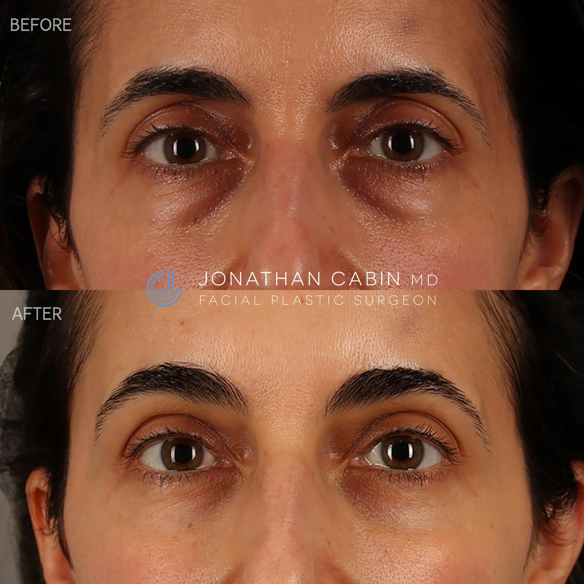Lower Blepharoplasty with Fat Grafting and Upper Eyelid Filler ...