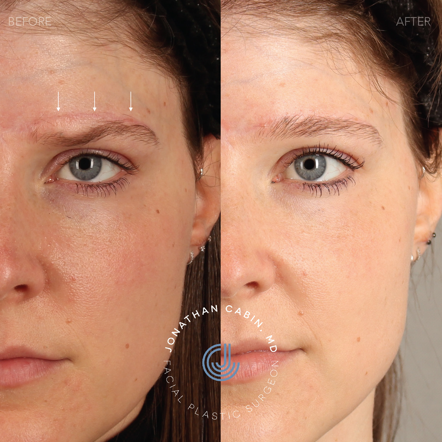 Nasal Reconstruction Cabinmd Facial Plastics And Aesthetics