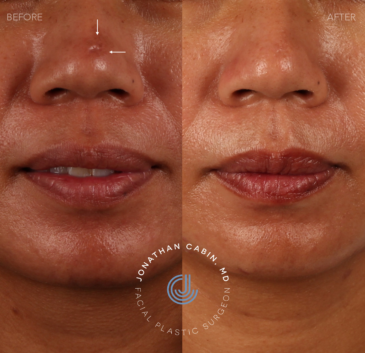 Scar Revision on Nasal Tip - CabinMD Facial Plastics & Aesthetics
