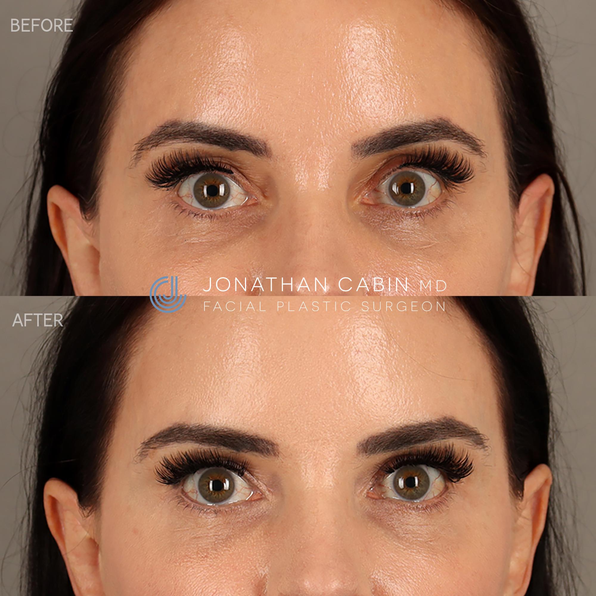 Upper Eyelid Filler - CabinMD Facial Plastics & Aesthetics