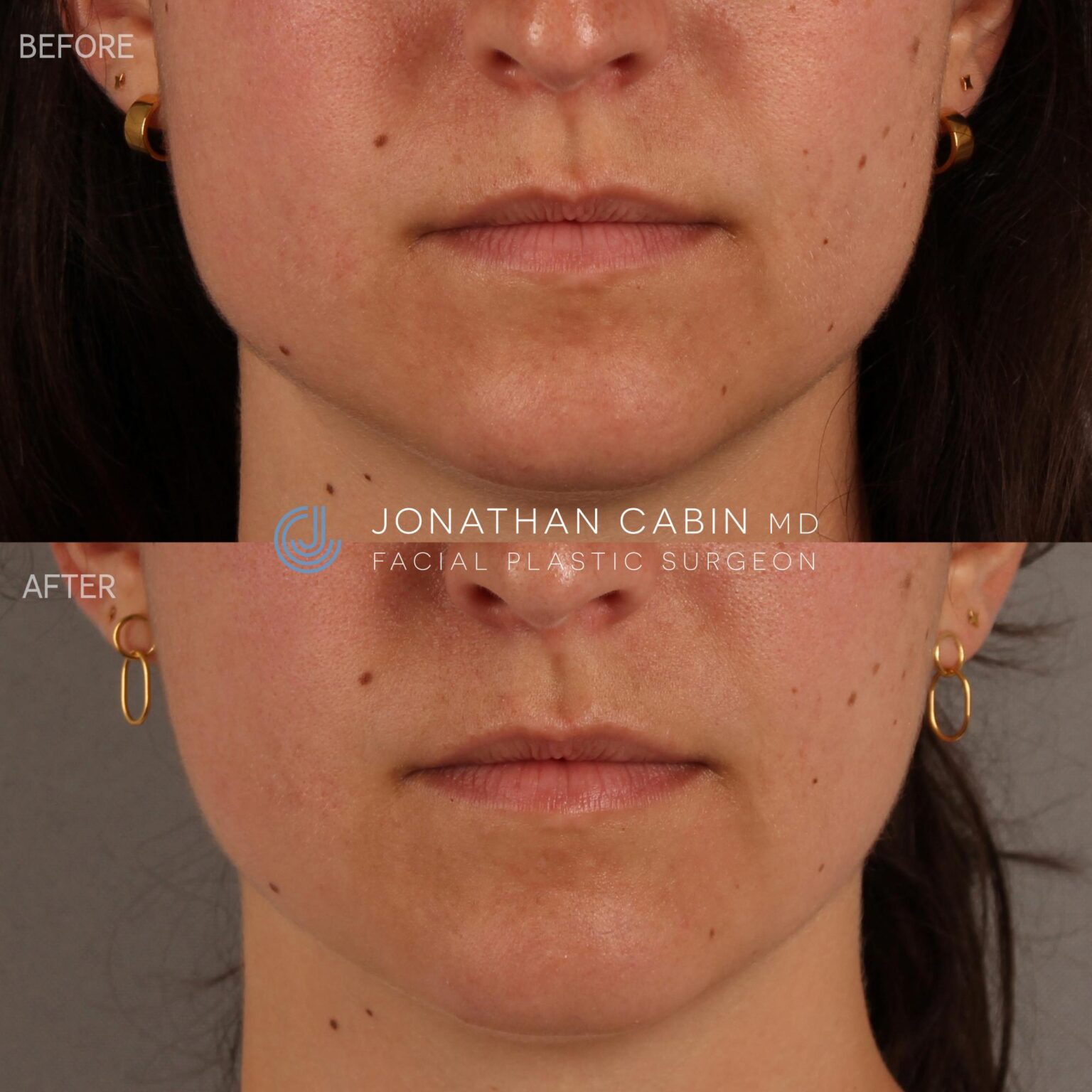 Facial Slimming Procedures Before & Afters | Dr. Jonathan Cabin