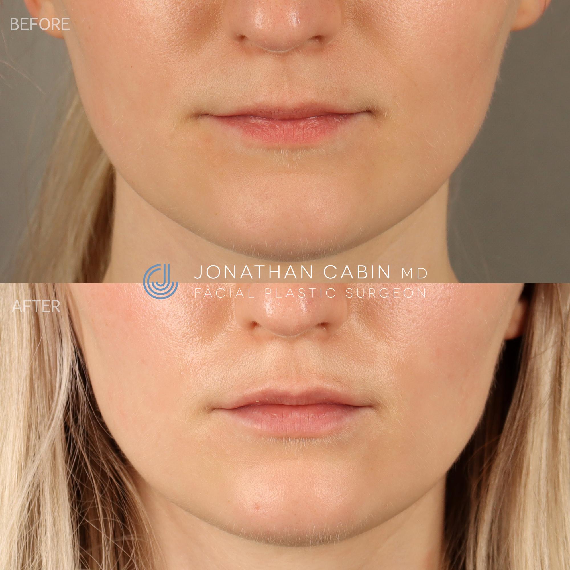 Lip Filler - CabinMD Facial Plastics & Aesthetics