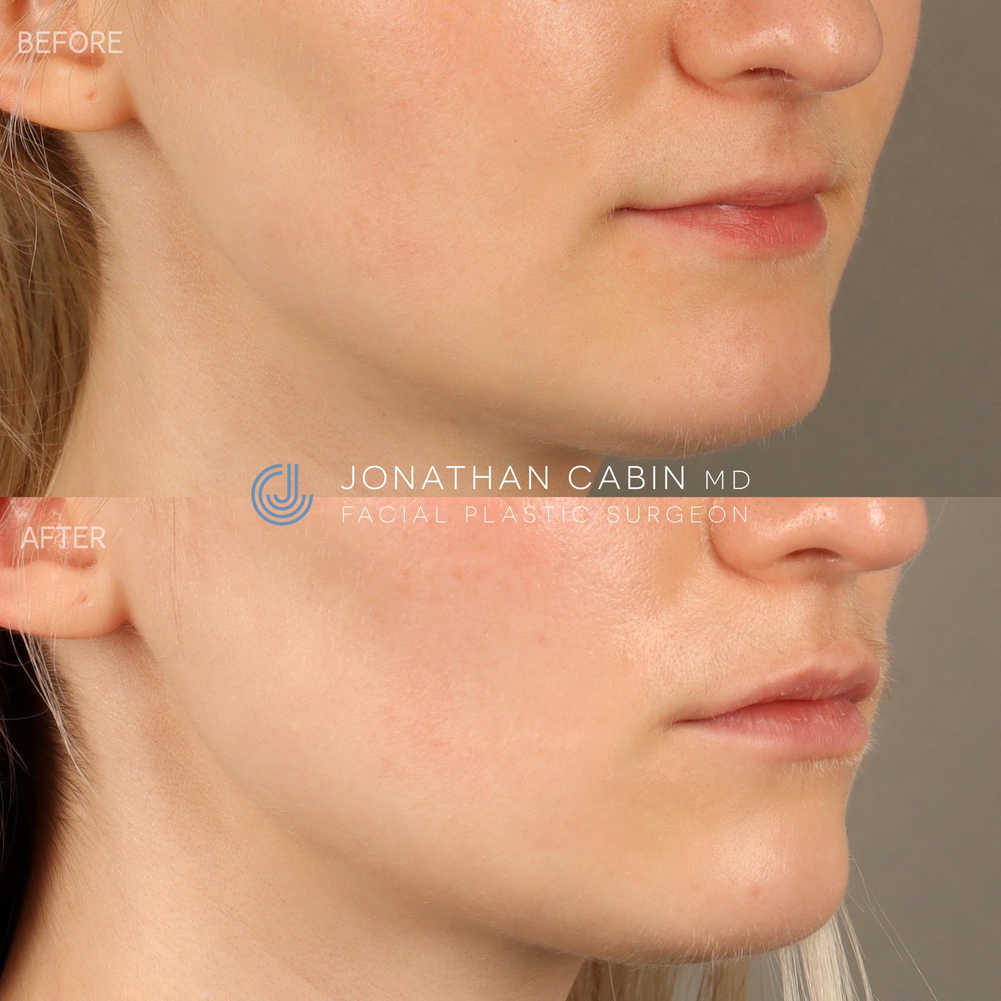 Lip Filler - CabinMD Facial Plastics & Aesthetics