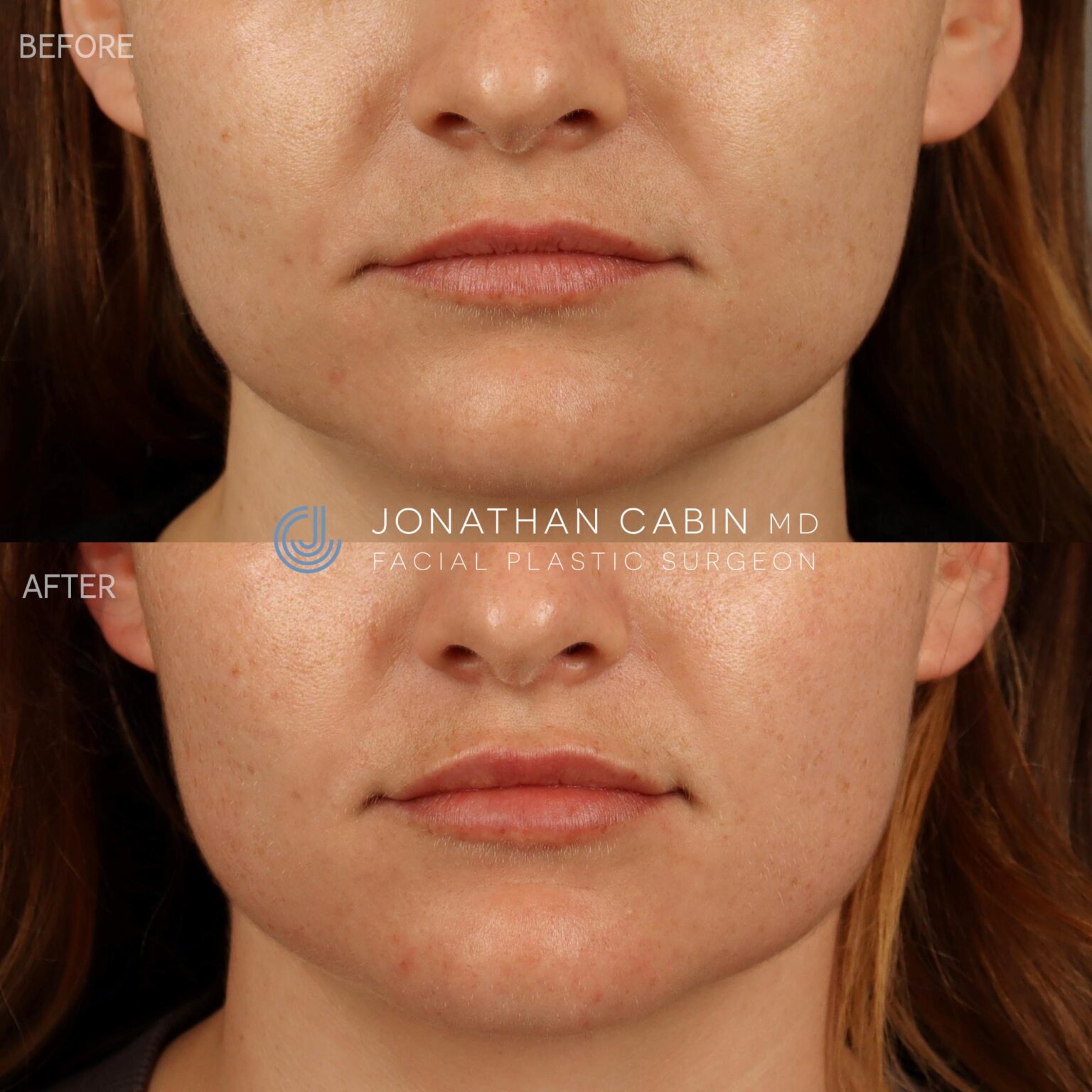 Non-Surgical Procedures Before & Afters | Dr. Jonathan Cabin