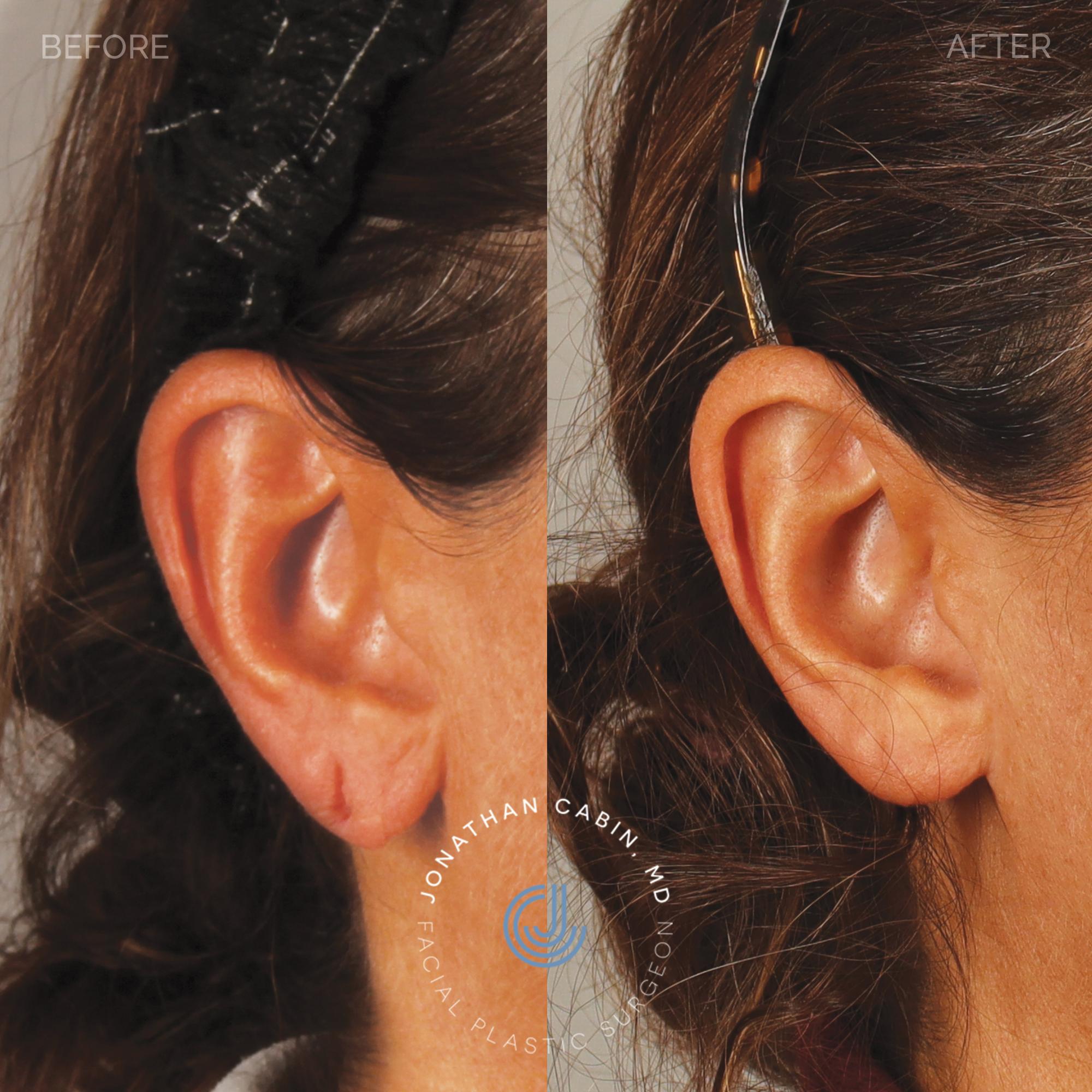 Earlobe Reduction Repair Cabinmd Facial Plastics Aesthetics