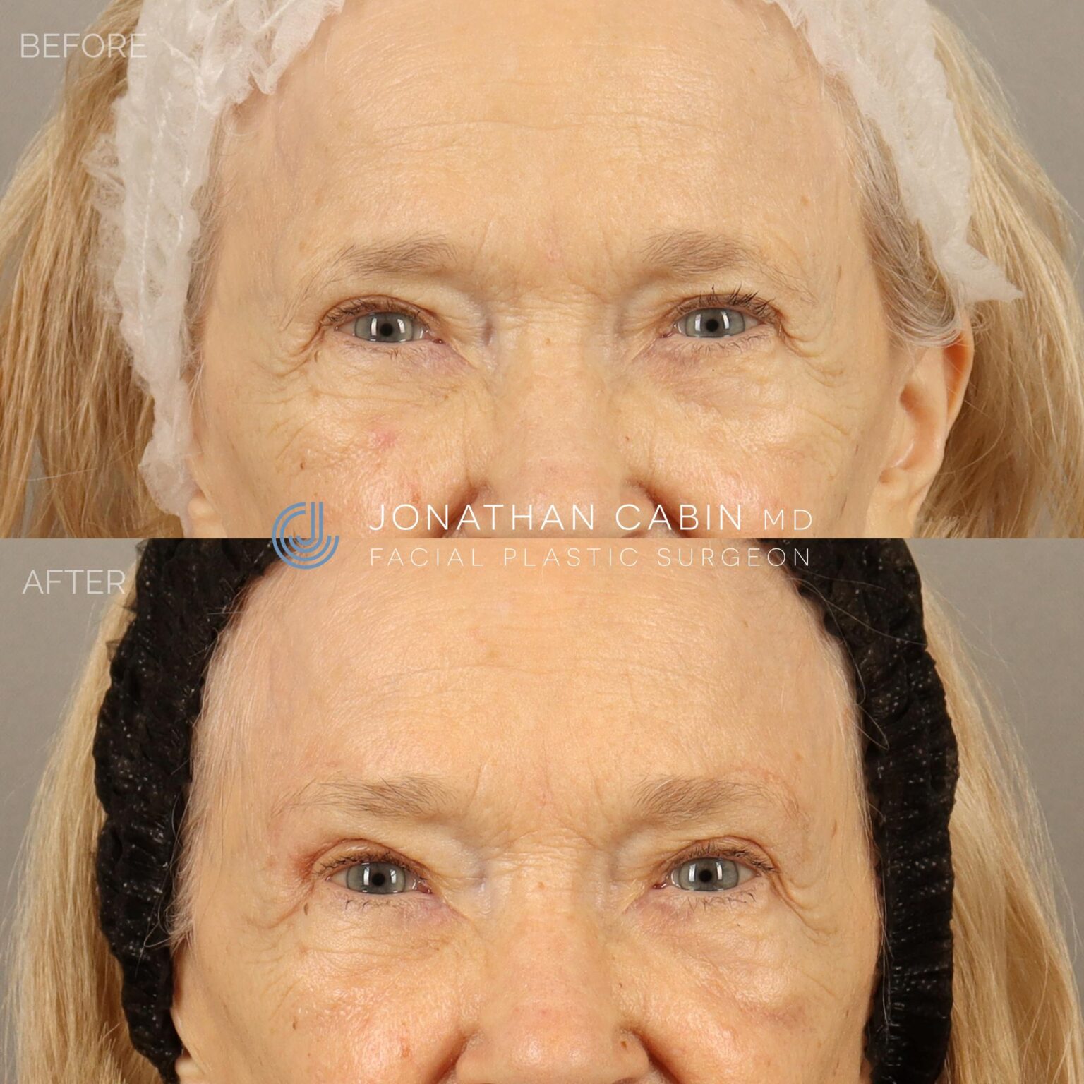Eye and Brow Procedures Before & Afters | Dr. Jonathan Cabin