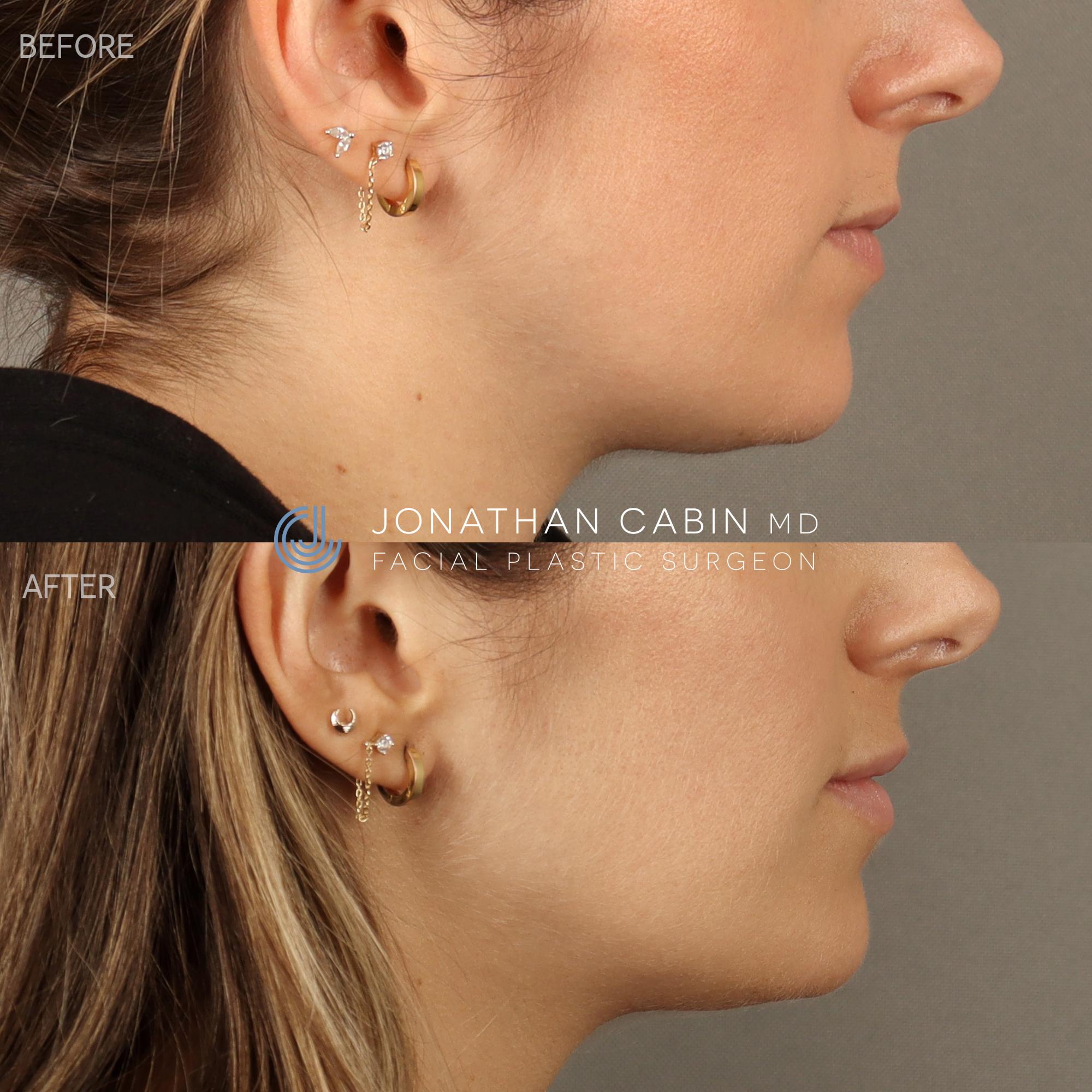 Lip Filler Dr Jonathan Cabin Lip Filler Dr Jonathan Cabin