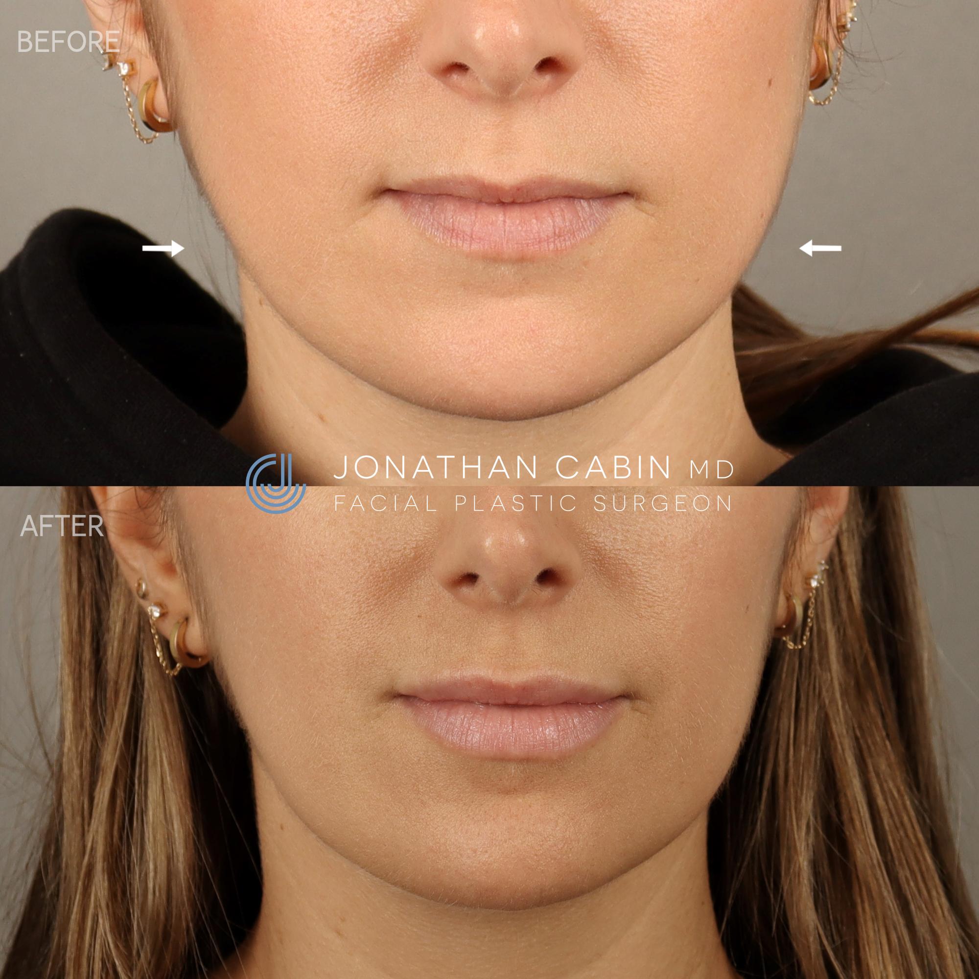 Non-Surgical Facial Slimming (with Lip Filler) - CabinMD Facial ...