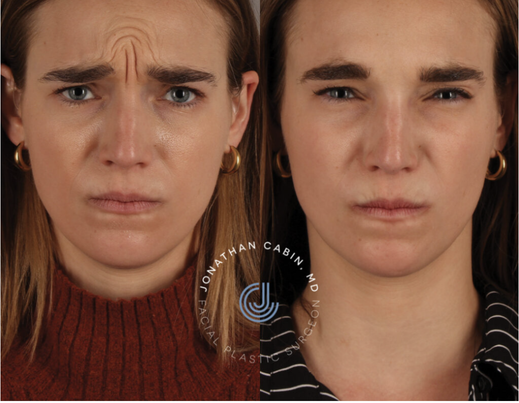 Latest Advances in Minimally Invasive Facial Aesthetic Procedures