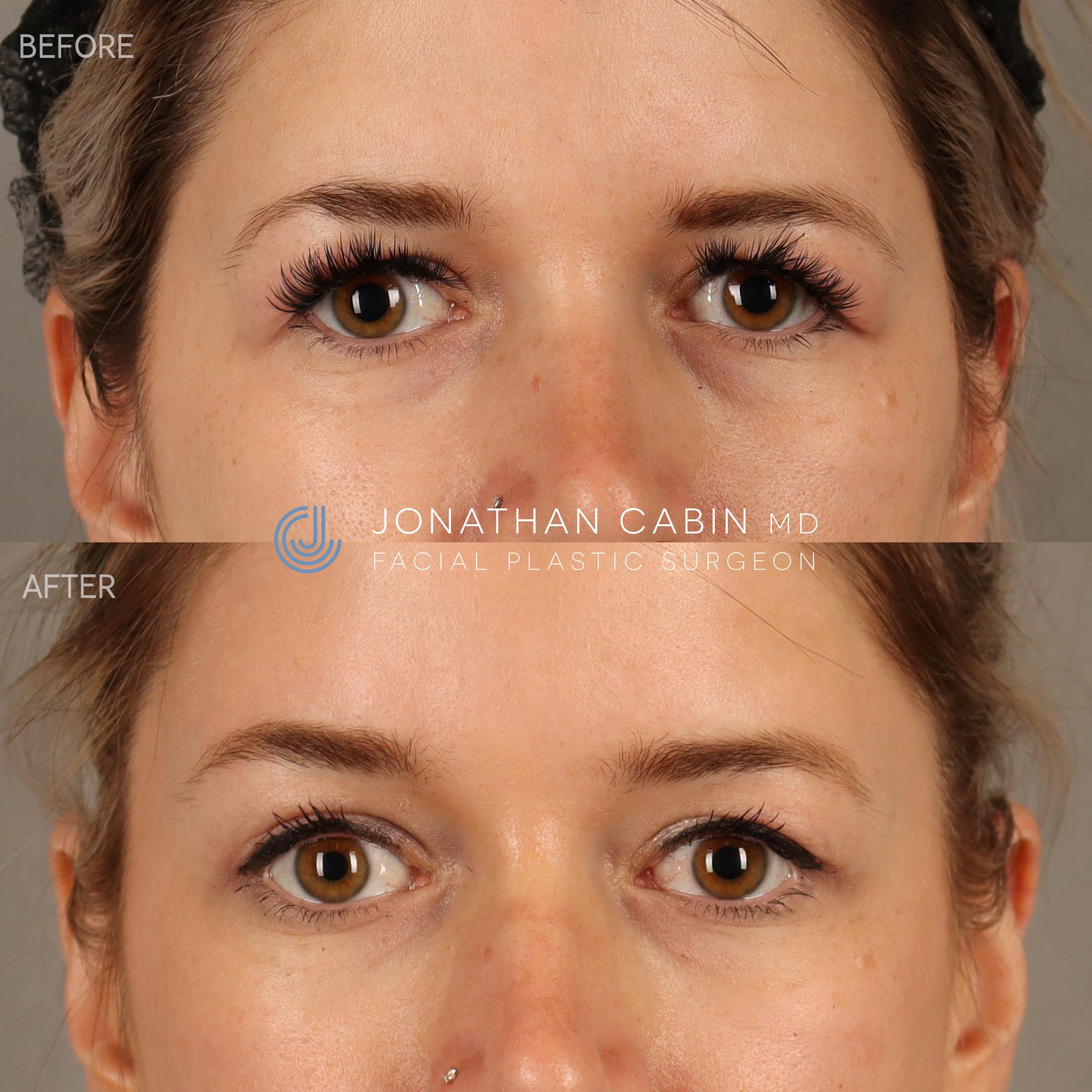 Temporal Brow Lift And Revision Upper Blepharoplasty Cabinmd Facial Plastics And Aesthetics