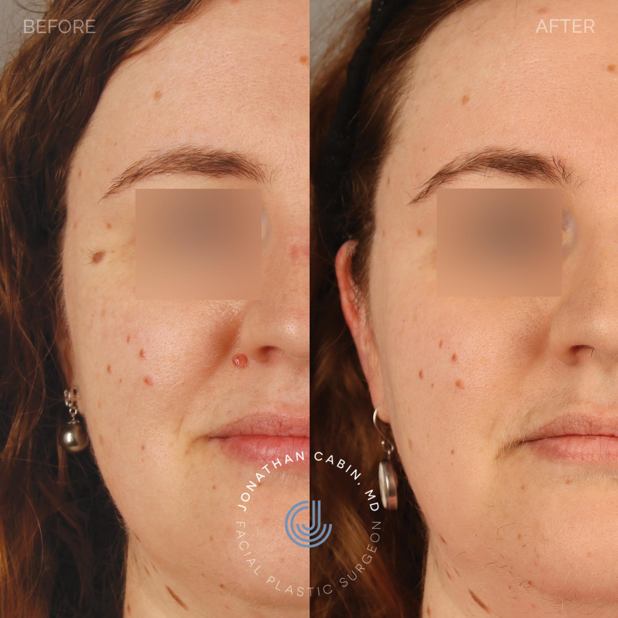 Mole Removal - CabinMD Facial Plastics & Aesthetics