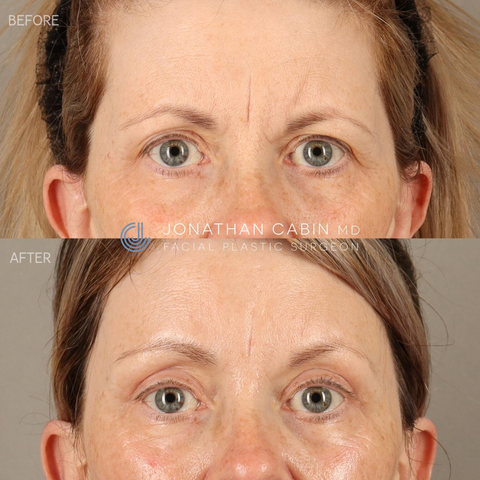 Eye and Brow Procedures Before & Afters | Dr. Jonathan Cabin