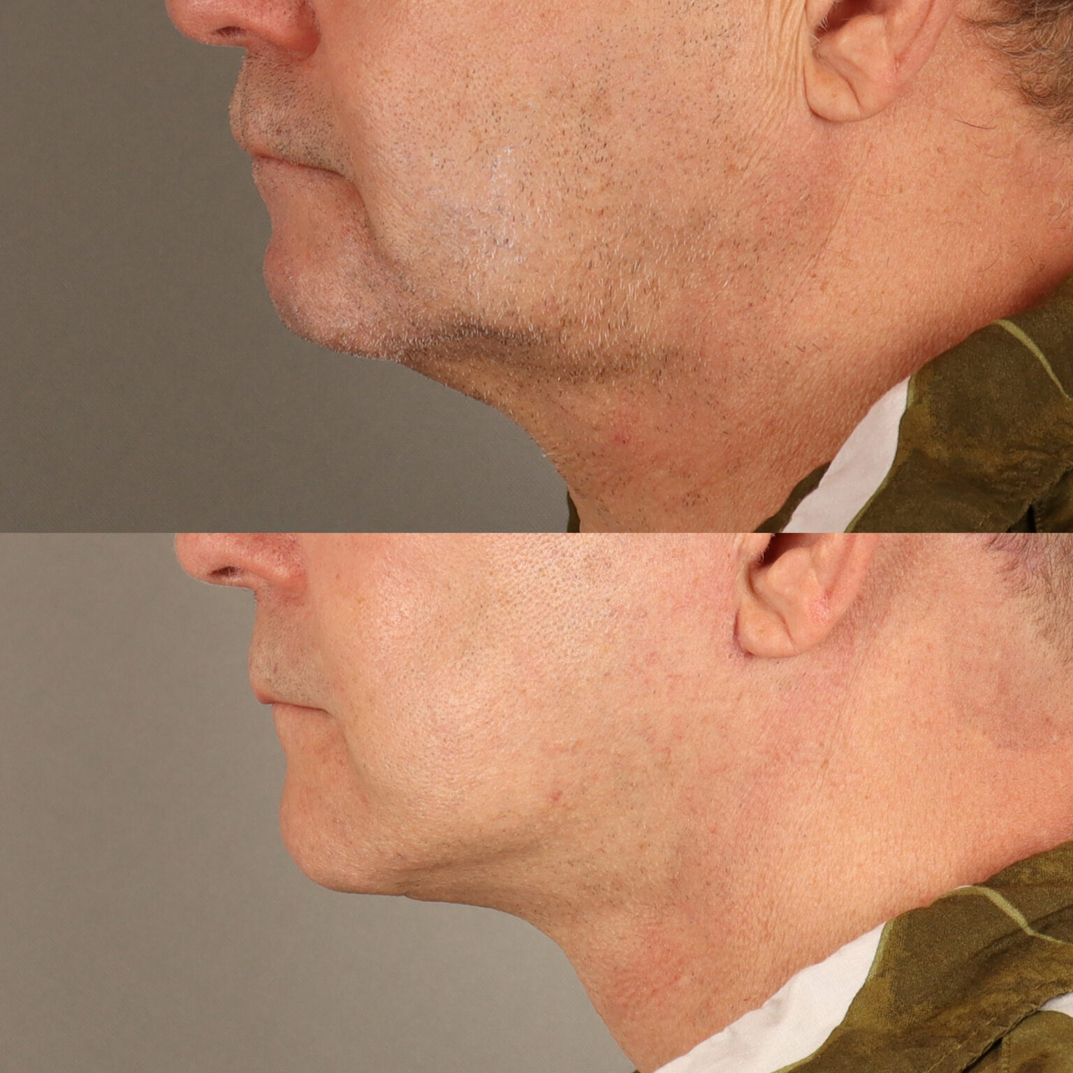 Face and Neck Procedures Before & Afters | Dr. Jonathan Cabin