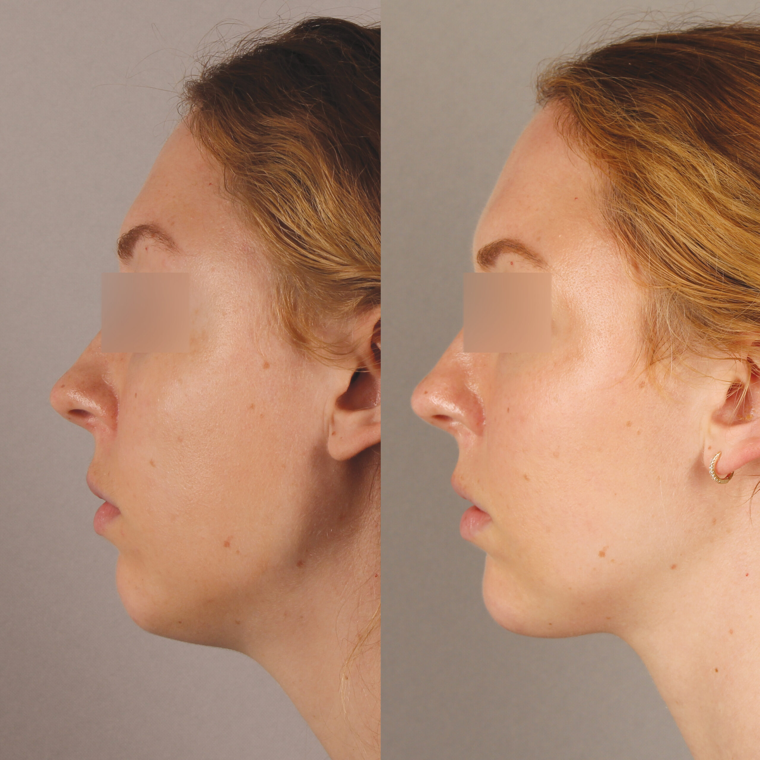 Chin Filler with Jawline Reduction Botox - CabinMD Facial Plastics ...