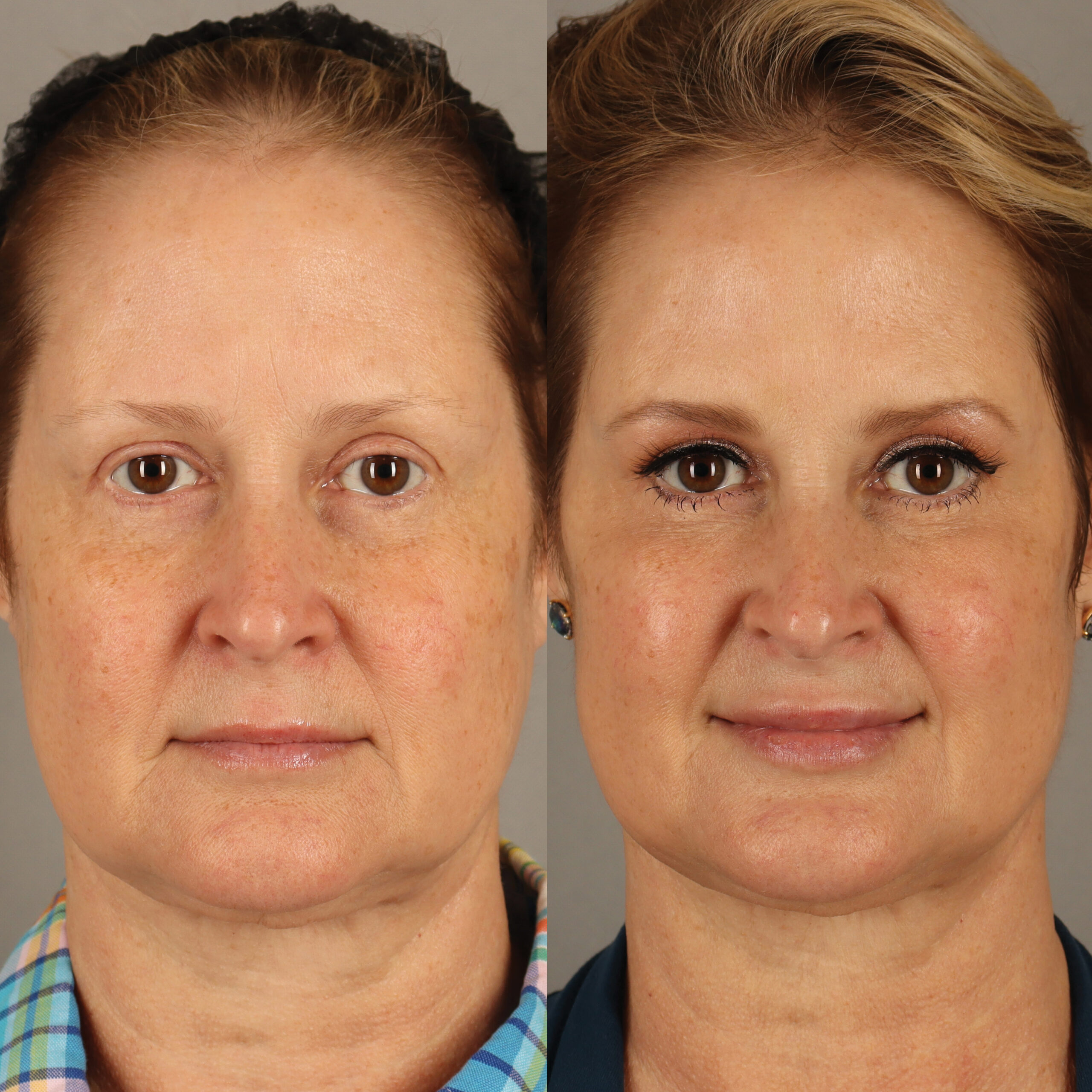 Lip and Cheek Filler - CabinMD Facial Plastics & Aesthetics
