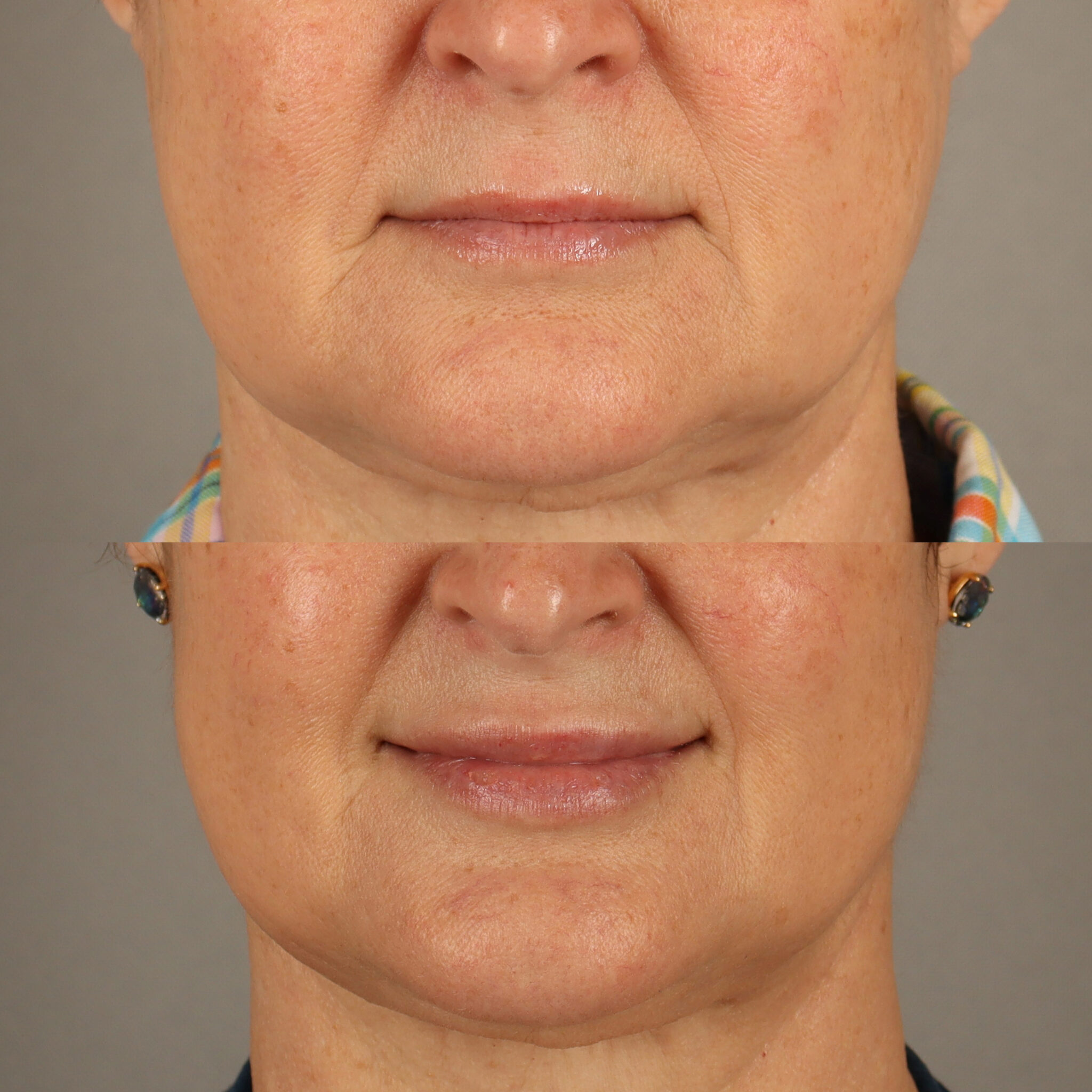 Lips Procedures Before & Afters | Dr. Jonathan Cabin