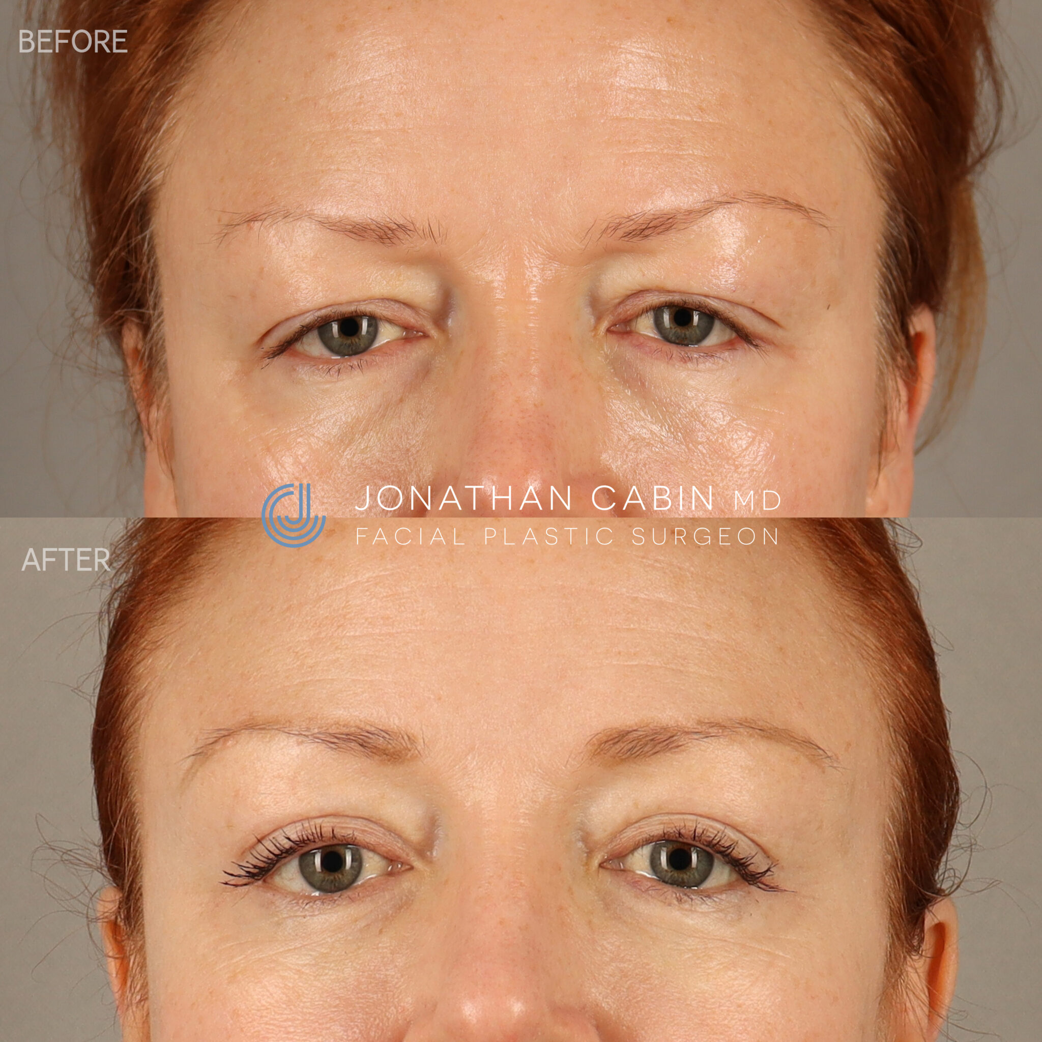 Eye and Brow Procedures Before & Afters | Dr. Jonathan Cabin