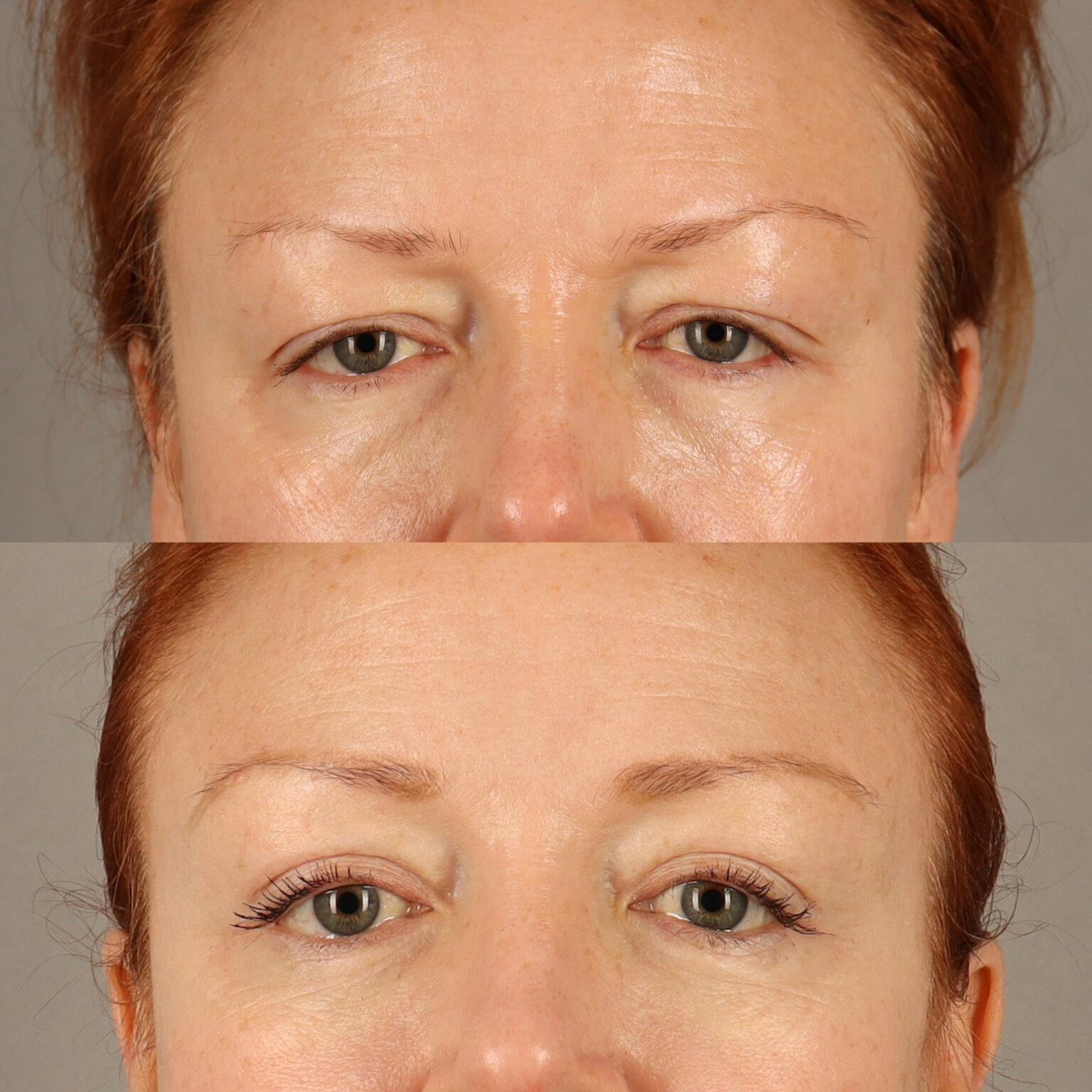 Eye and Brow Procedures Before & Afters | Dr. Jonathan Cabin