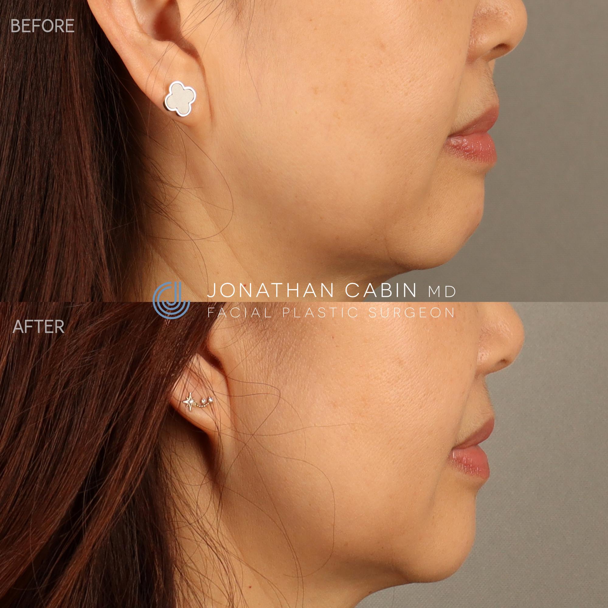 Lower Facial Filler - CabinMD Facial Plastics & Aesthetics