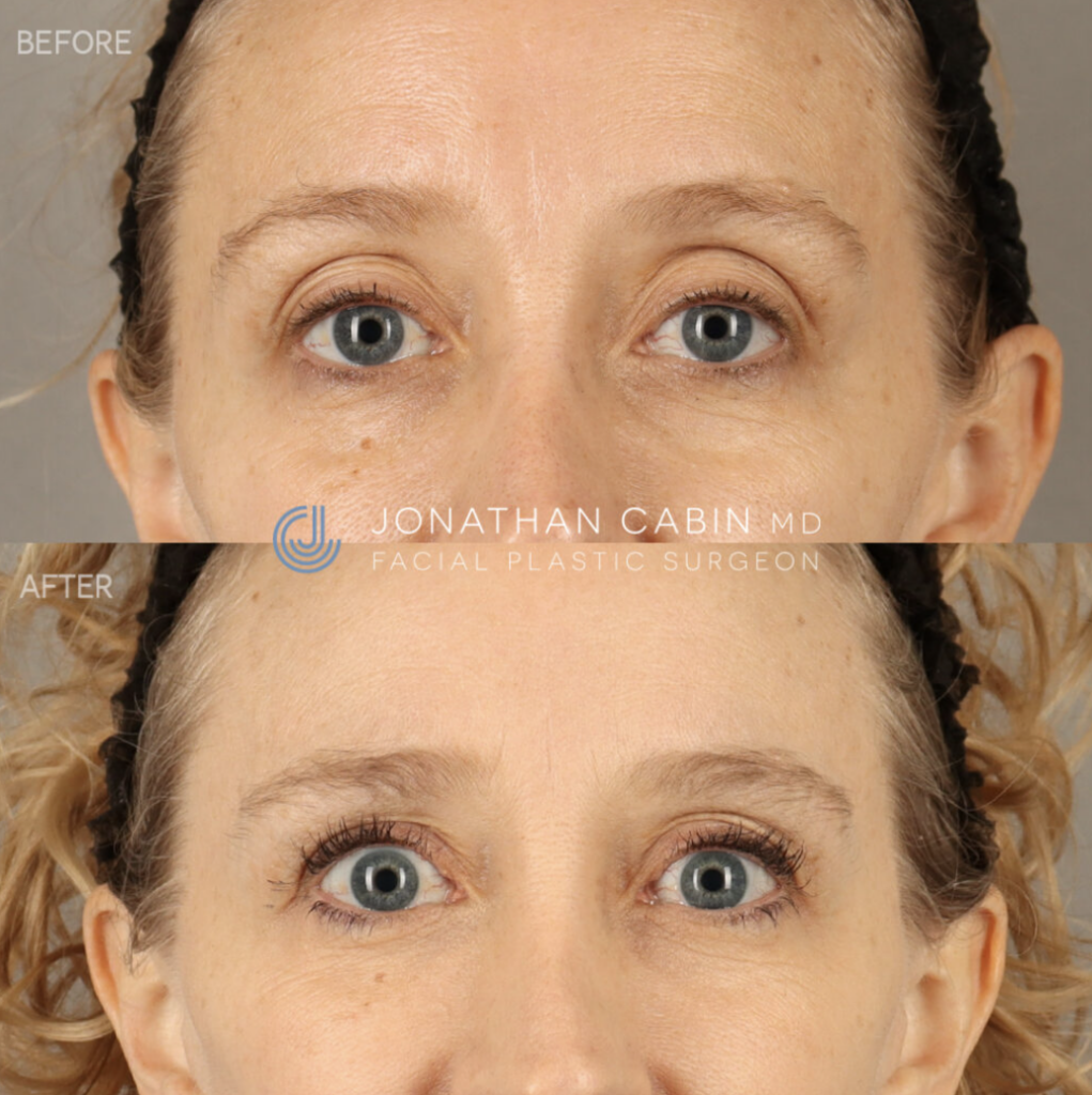 5 Benefits of Facial Fat Grafting | CabinMD Facial Plastics & Aesthetics
